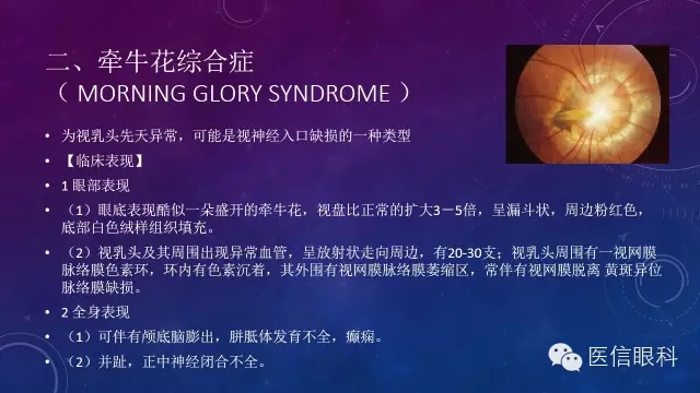 Foster-Kennedy综合征，典型的表现为一侧视神经萎缩，一侧视乳头水肿，多由颅内肿瘤压迫导致，所以看到这个表现，一定要做一个头颅的影像学检查