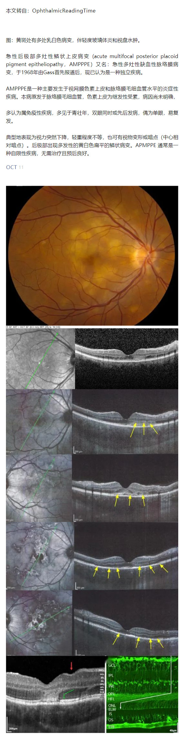 OCT学习精要 | 急性后极部多灶性鳞状色素上皮病变APMPPE_www.yanke360.com